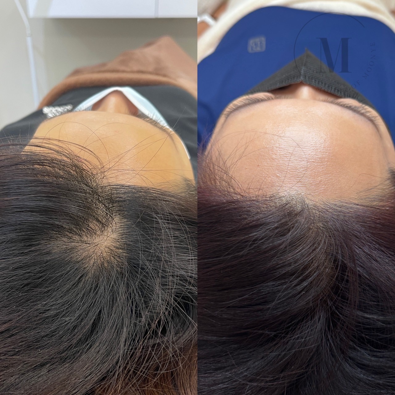 新竹頭皮育髮耘髮 - SLook.eyelash半永久紋繡/紋髮際線/角蛋白美睫設計/皮膚管理